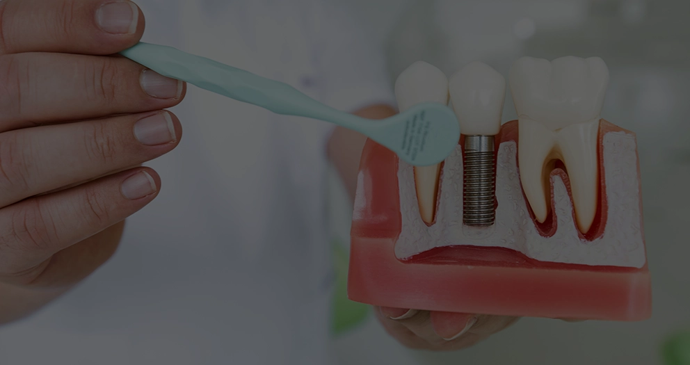 Dental Implant Restorations - Baker Family & Cosmetic Dentistry ...